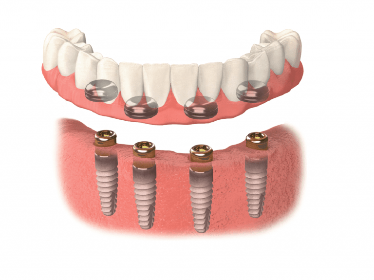 Implantatgestüzte Stegprothese - Zahnklinik Globe Dental Ungarn