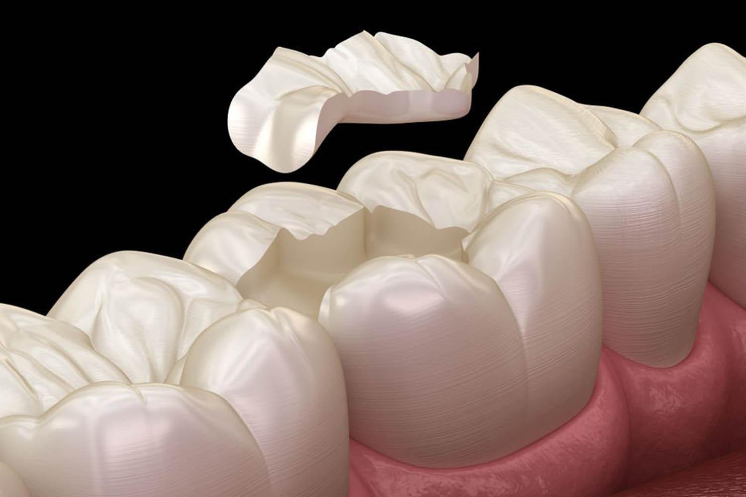 Inlays, onlays - Zahnklinik Globe Dental Ungarn